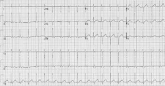 Supraventricular Tachycardia (SVT) • LITFL • ECG Library Diagnosis