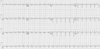 Supraventricular Tachycardia (SVT) • LITFL • ECG Library Diagnosis