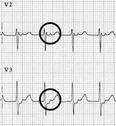 Supraventricular Tachycardia (SVT) • LITFL • ECG Library Diagnosis