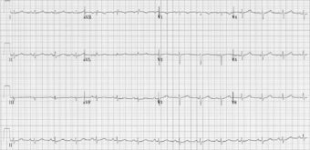 Supraventricular Tachycardia (SVT) • LITFL • ECG Library Diagnosis