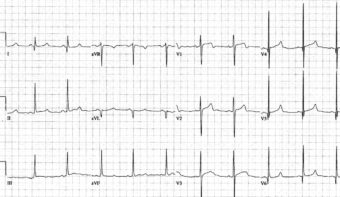 Hypertrophic Cardiomyopathy (HCM) • LITFL • ECG Library Diagnosis