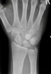 Top 10 X-Ray Foreign Bodies • LITFL • Arcanum veritas