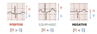 ECG Axis Interpretation • LITFL • ECG Library Basics