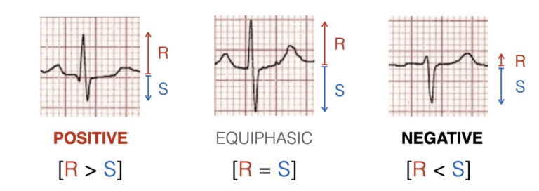 ECG Axis Interpretation • LITFL • ECG Library Basics