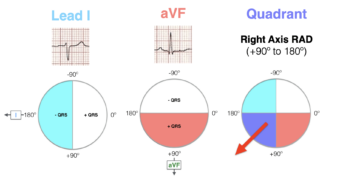 ECG Axis Interpretation • LITFL • ECG Library Basics
