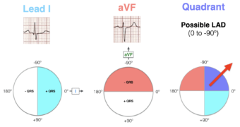 ECG Axis Interpretation • LITFL • ECG Library Basics