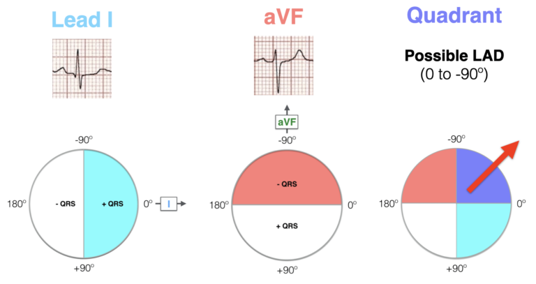ECG Axis Interpretation • LITFL • ECG Library Basics