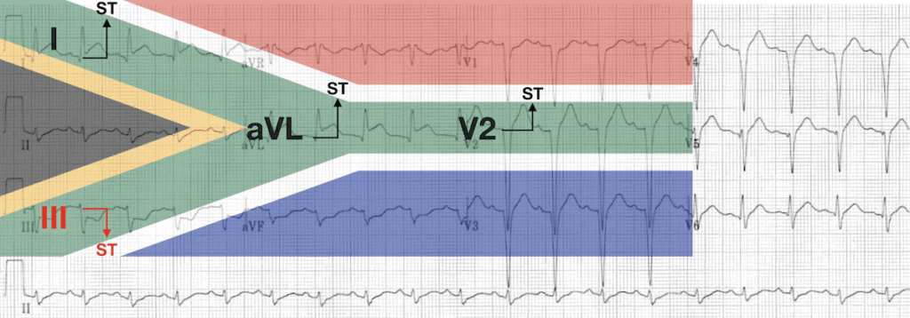 High Lateral STEMI • LITFL • ECG Library Diagnosis