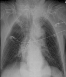 Top 10 X-Ray Foreign Bodies • LITFL • Arcanum veritas