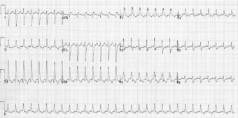 Idiopathic Fascicular Left Ventricular Tachycardia • LITFL • ECG Library