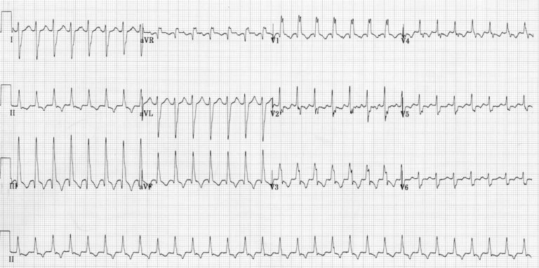 Idiopathic Fascicular Left Ventricular Tachycardia • LITFL • ECG Library