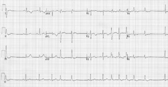 Idiopathic Fascicular Left Ventricular Tachycardia • LITFL • ECG Library