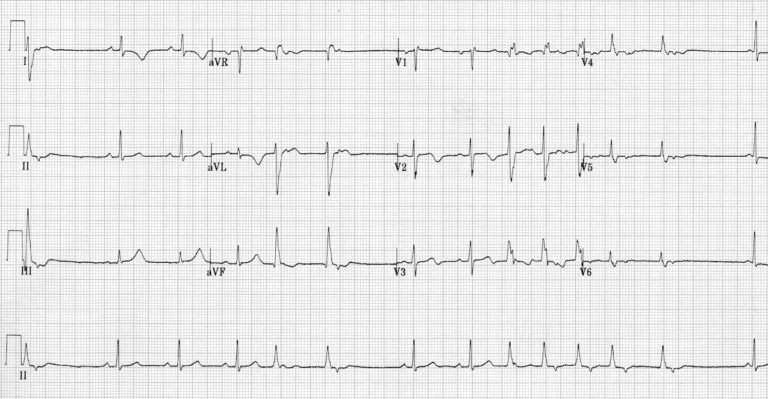 Idiopathic Fascicular Left Ventricular Tachycardia • LITFL • ECG Library
