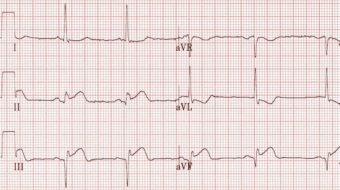Q Wave • LITFL • ECG Library Basics