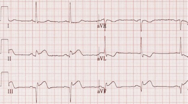 Q Wave • LITFL • ECG Library Basics