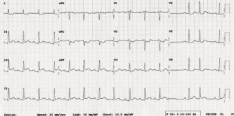 Right Ventricular Infarction • LITFL • ECG Library Diagnosis