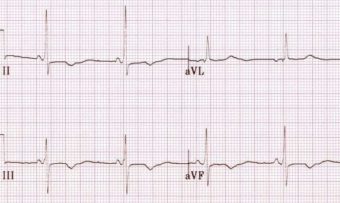 T wave • LITFL • ECG Library Basics