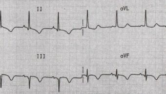 T wave • LITFL • ECG Library Basics