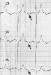 U Wave • LITFL Medical Blog • ECG Library Basics