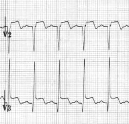 U Wave • LITFL Medical Blog • ECG Library Basics