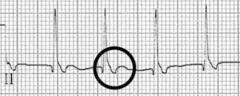 Supraventricular Tachycardia (SVT) • LITFL • ECG Library Diagnosis
