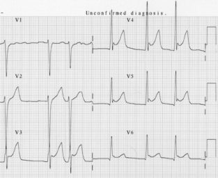 Osborn Wave (J Wave) • LITFL • ECG Library Basics