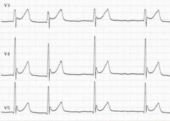 Osborn Wave (J Wave) • LITFL • ECG Library Basics