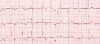T wave • LITFL • ECG Library Basics