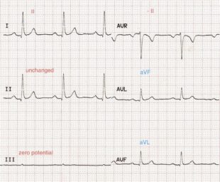 ECG Limb Lead Reversal • LITFL • ECG Library Diagnosis