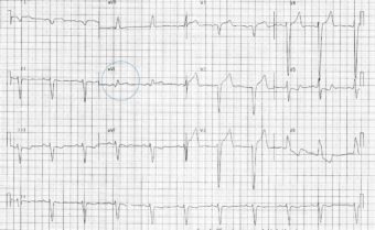 Sgarbossa Criteria • LITFL • ECG Library Diagnosis