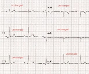 ECG Limb Lead Reversal • LITFL • ECG Library Diagnosis