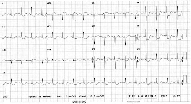 ST Elevation in aVR • LITFL • ECG Library Diagnosis