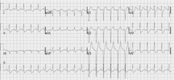ST Elevation in aVR • LITFL • ECG Library Diagnosis