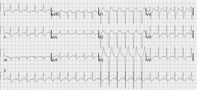 ST Elevation in aVR • LITFL • ECG Library Diagnosis