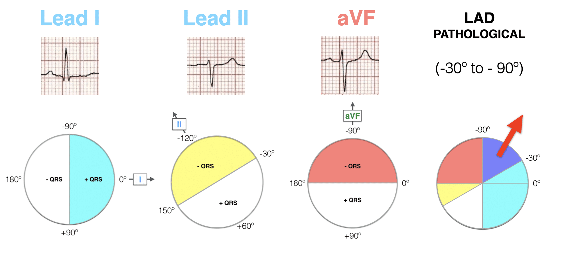 Left Axis Deviation LAD LITFL ECG Library Diagnosis Left Axis Deviation LAD LITFL ECG Library Diagnosis