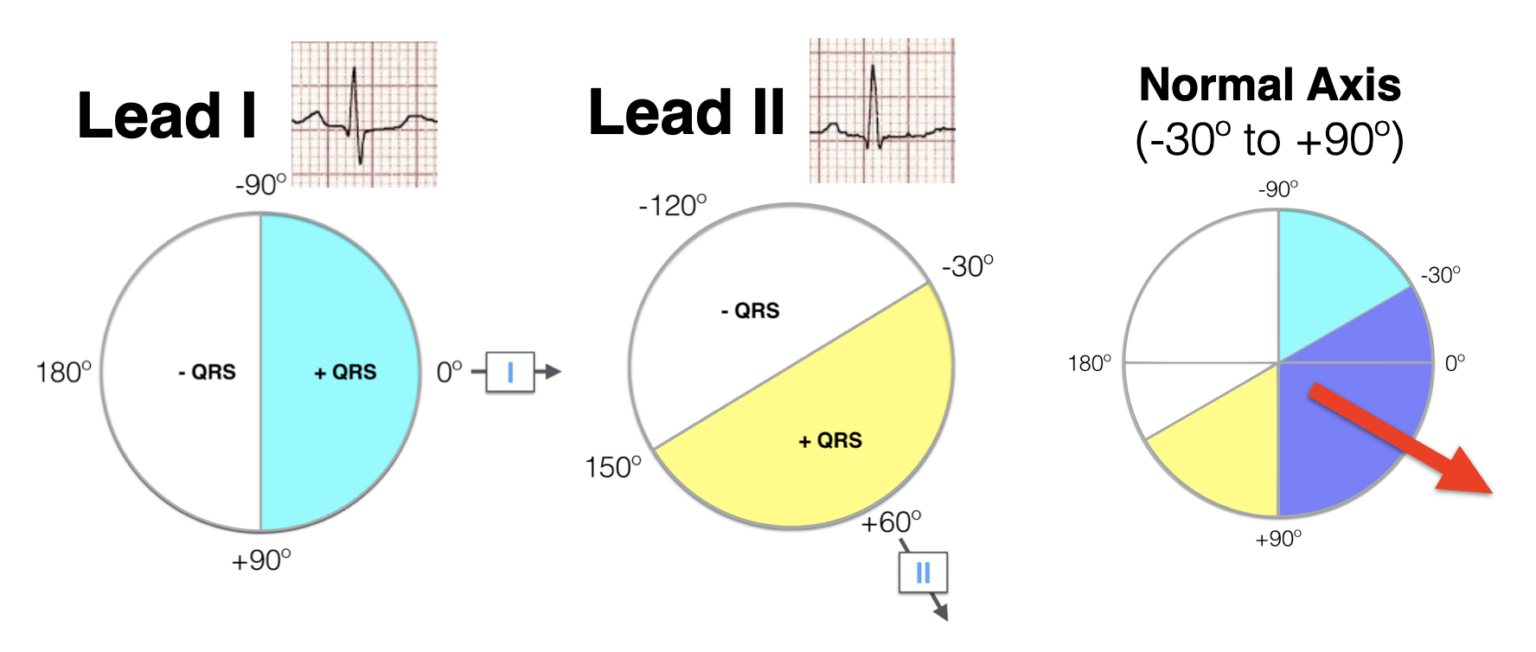 ECG Axis Interpretation • LITFL • ECG Library Basics