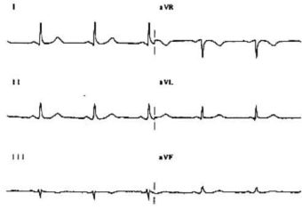 ECG Limb Lead Reversal • LITFL • ECG Library Diagnosis