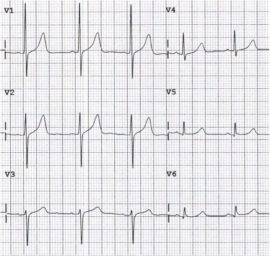 Poor R Wave Progression (PRWP) • LITFL • ECG Library Diagnosis