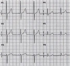 R wave • LITFL • ECG Library Basics