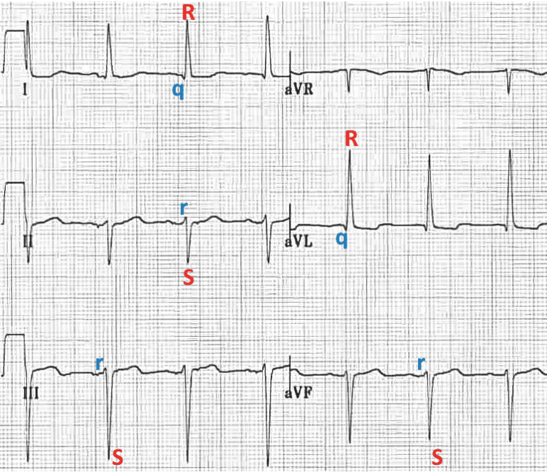 Left Anterior Fascicular Block (LAFB) • LITFL • ECG Library Diagnosis