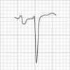 P wave • LITFL • ECG Library Basics