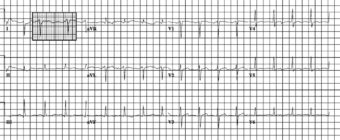 Left Posterior Fascicular Block (LPFB) • LITFL • ECG Library Diagnosis
