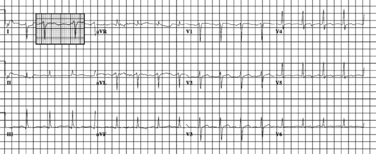 Left Posterior Fascicular Block (LPFB) • LITFL • ECG Library Diagnosis