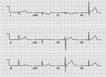 Left Posterior Fascicular Block (LPFB) • LITFL • ECG Library Diagnosis