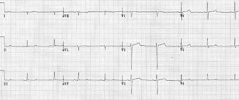 Left Posterior Fascicular Block (LPFB) • LITFL • ECG Library Diagnosis