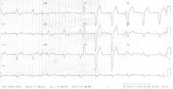 Left Bundle Branch Block (LBBB) • LITFL • ECG Library Diagnosis