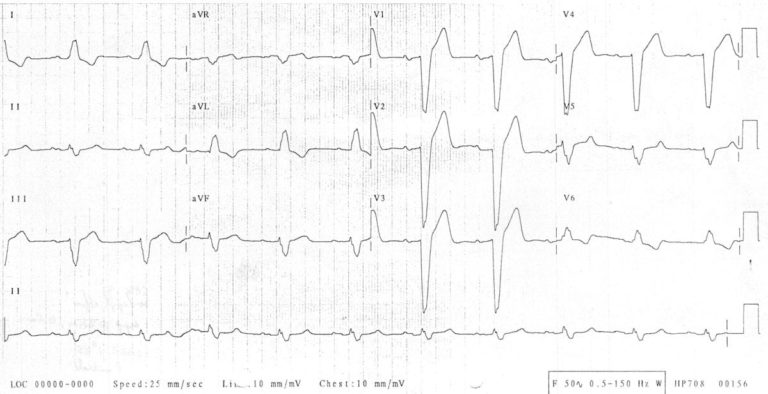Left Bundle Branch Block (LBBB) • LITFL • ECG Library Diagnosis