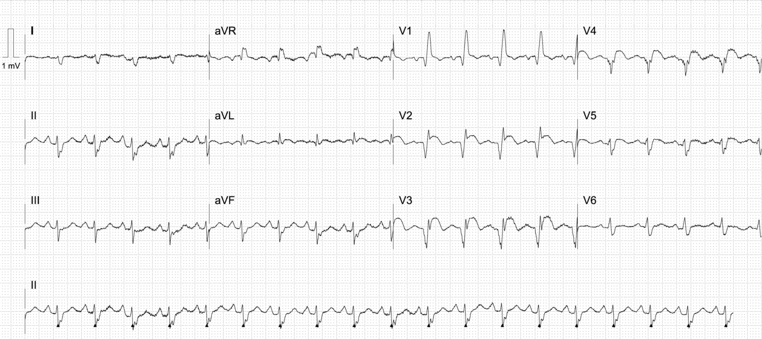 Left Ventricular Aneurysm • LITFL • ECG Library Diagnosis