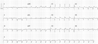 Left Ventricular Aneurysm • LITFL • ECG Library Diagnosis