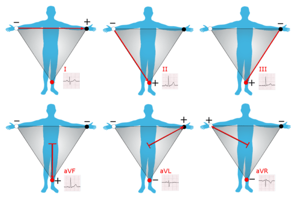 ECG Limb Lead Reversal • LITFL • ECG Library Diagnosis